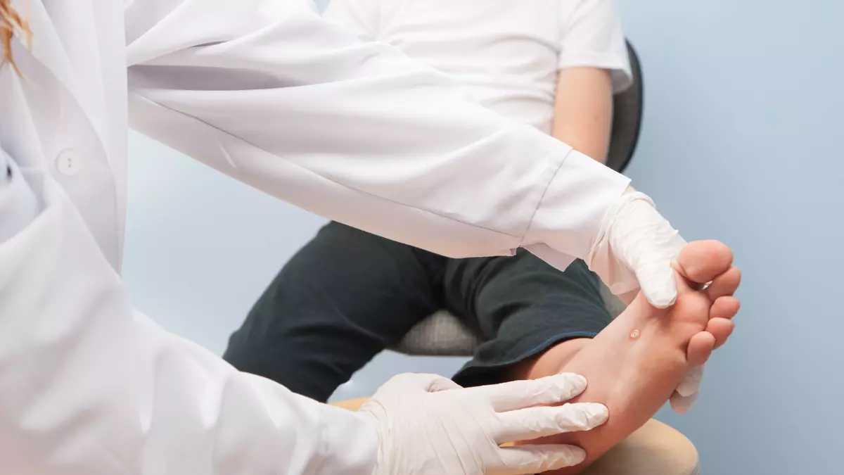 Cosa fare in caso di verruche e molluschi contagiosi - Dermatologo ...